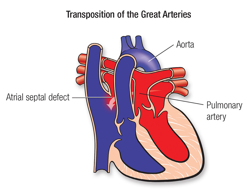 d-Transposition of the Great Arteries | American Stroke Association