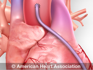 Heart Procedures and Surgeries | American Stroke Association