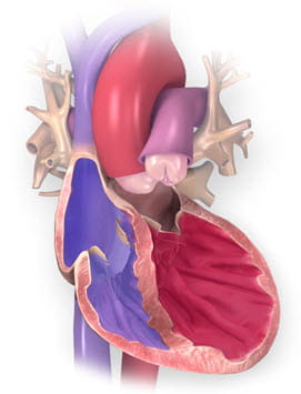 Heart Failure | American Stroke Association
