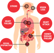 Health Threats From High Blood Pressure American Stroke Association Health Threats From High Blood Pressure American Stroke Association