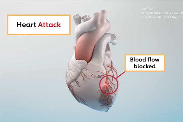 Heart attack vs. cardiac arrest: What's the difference? | American Stroke Association ...