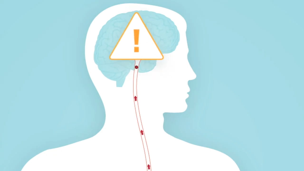 Why Atrial Fibrillation Matters | American Stroke Association