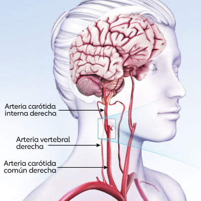 Ataque isquémico transitorio (AIT) | American Stroke Association ...