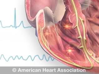 Cardioversion | American Stroke Association