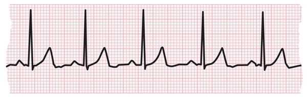 Tachycardia: Fast Heart Rate | American Stroke Association