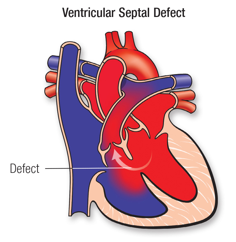 Ventricular Septal Defect (VSD) | American Stroke Association