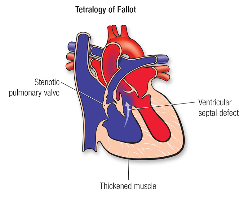 Congestive Heart Failure and Congenital Defects | American Stroke ...