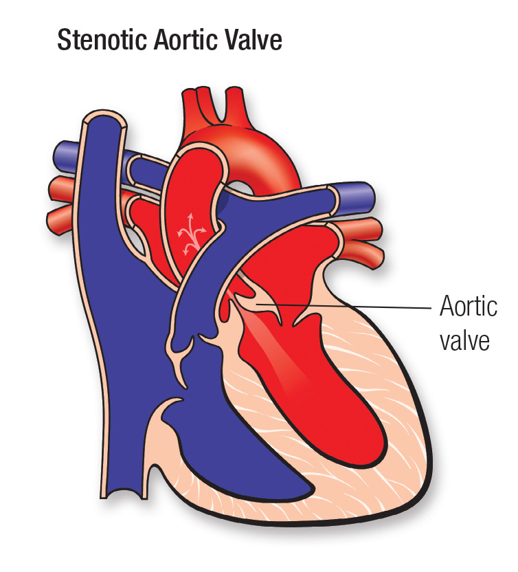 Total de conexión venosa pulmonar anómala (TAPVC) | American Stroke ...